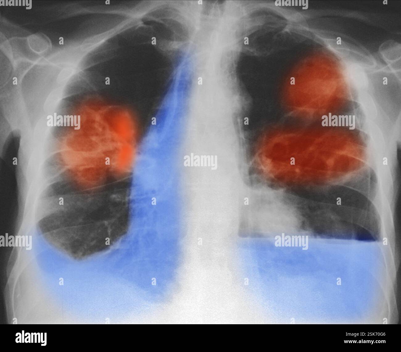 Pneumonie bactérienne. Radiographie frontale colorée des poumons chez ...