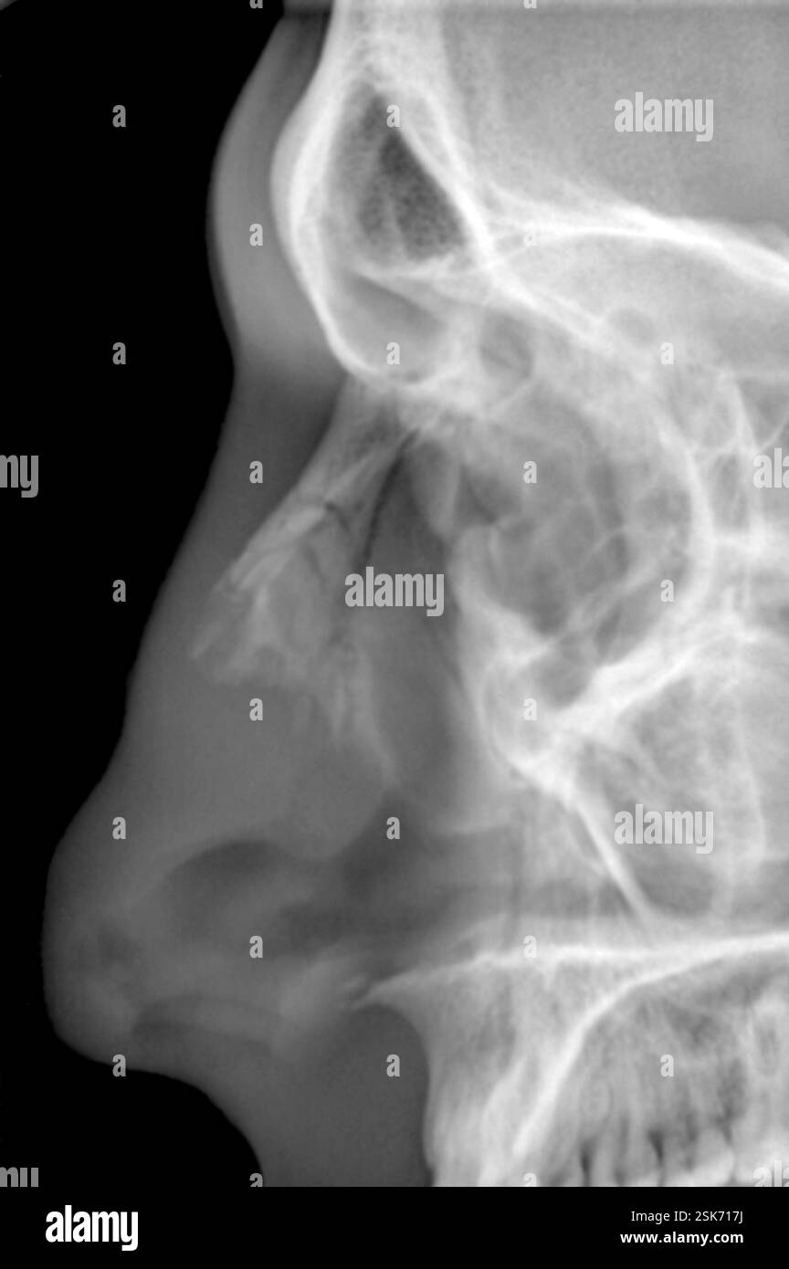 Fractures des os du nez. Radiographie latérale du nez chez un homme de ...