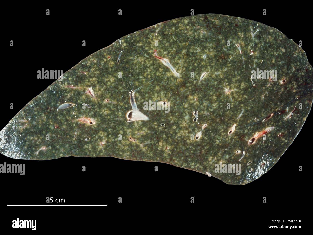 ECHANTILLON macroscopique d'un foie atteint de cholestase. La ...
