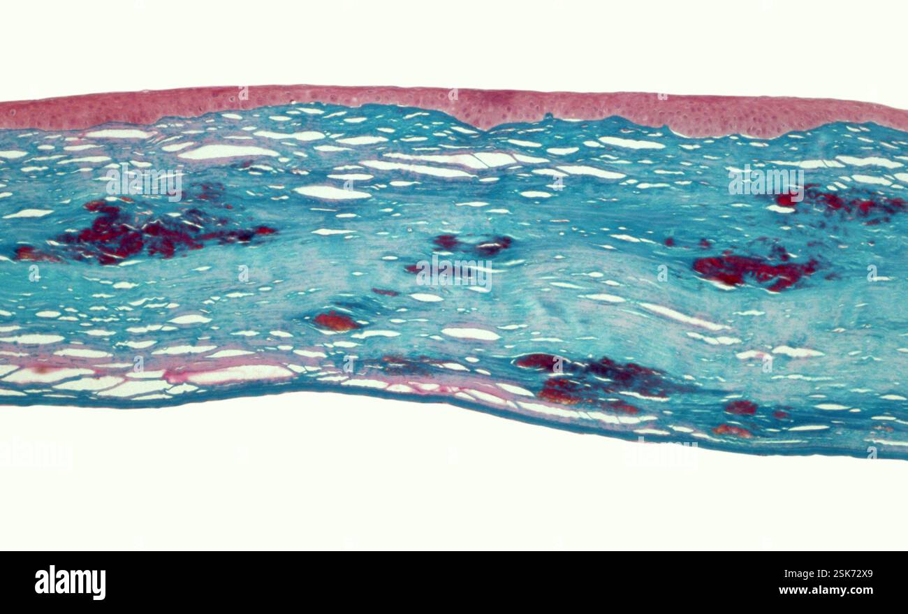 Photomicrographie du stroma cornéen d'un patient atteint de dystrophie ...