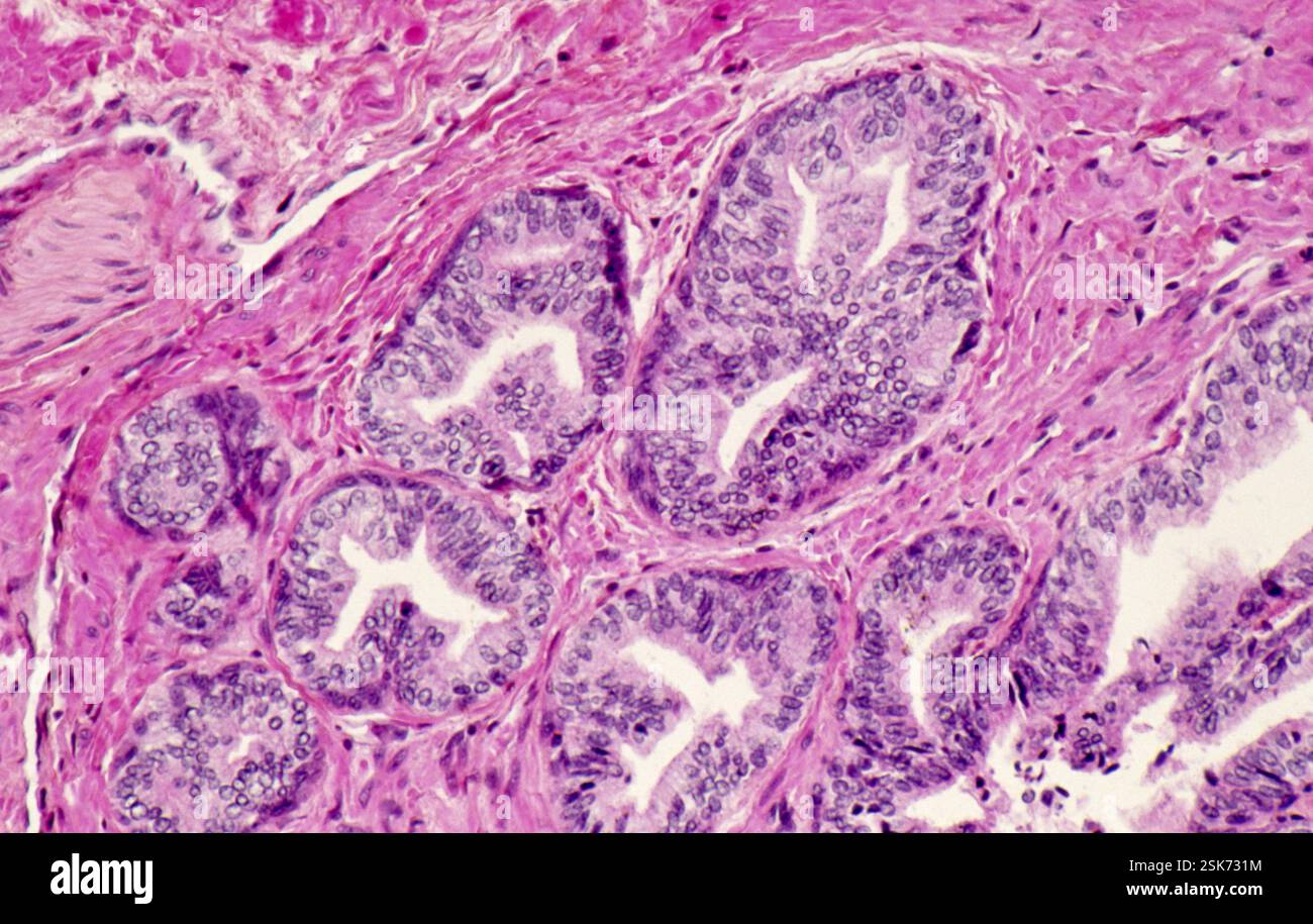 Micrographie lumineuse d'un adénome de la prostate, montrant une ...
