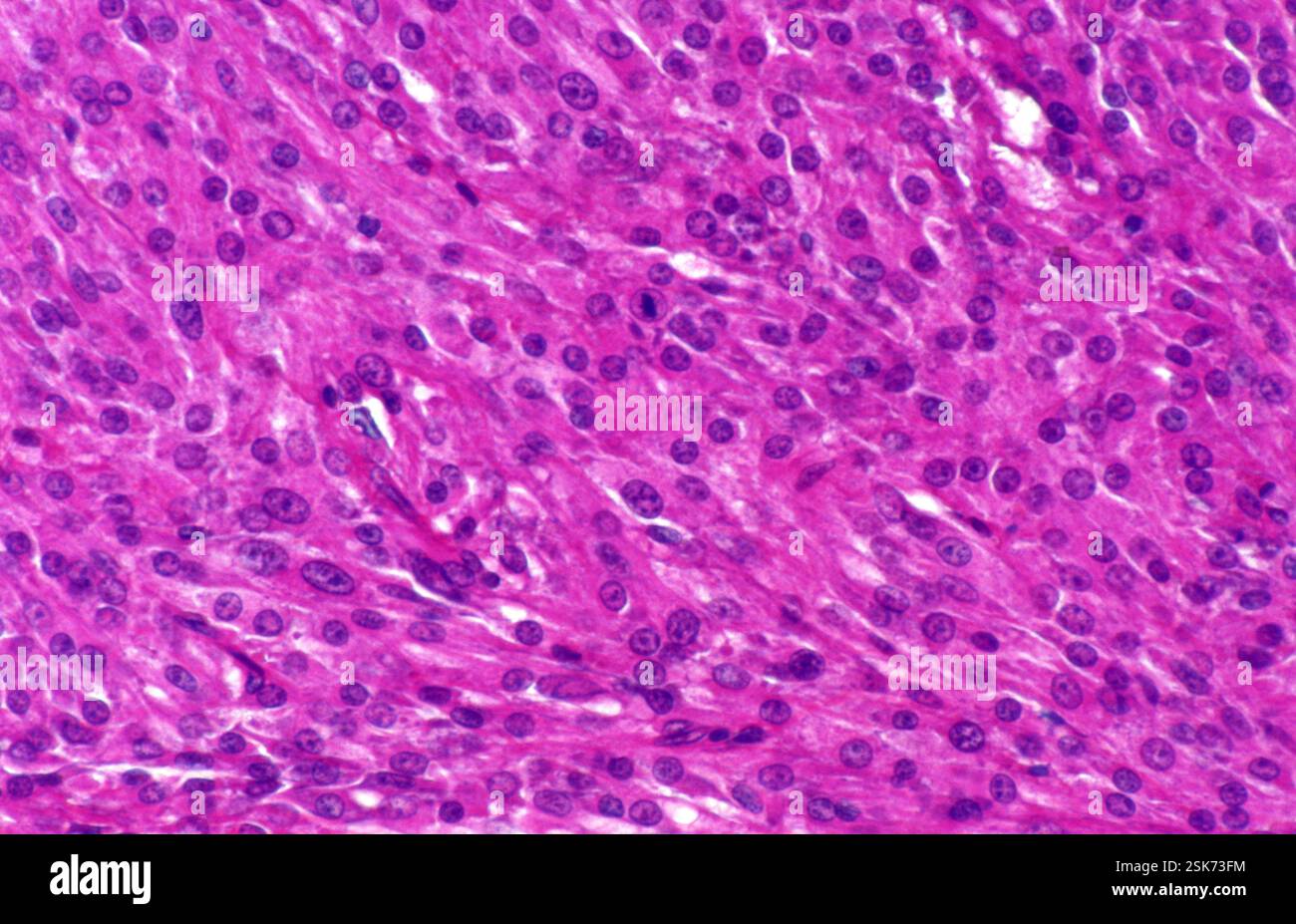 Micrographie lumineuse d'une tumeur testiculaire à cellules de leydig ...