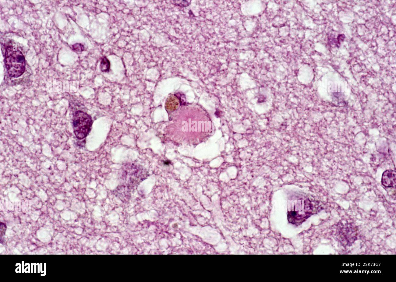Micrographie lumineuse montrant une section d'un cerveau atteint de la ...