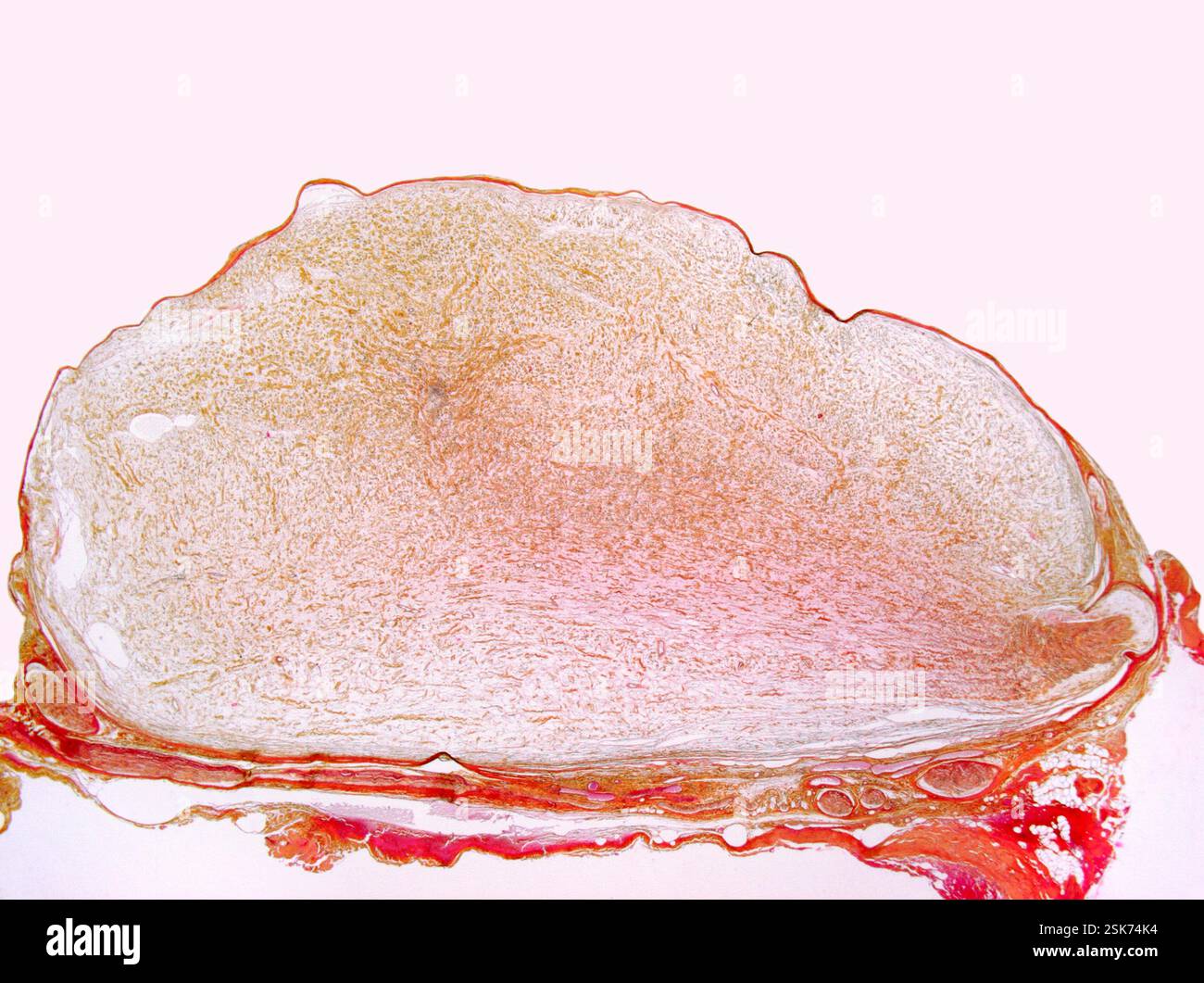 Tumeur nerveuse. Micrographie optique d'une coupe d'un neurofibrome ...