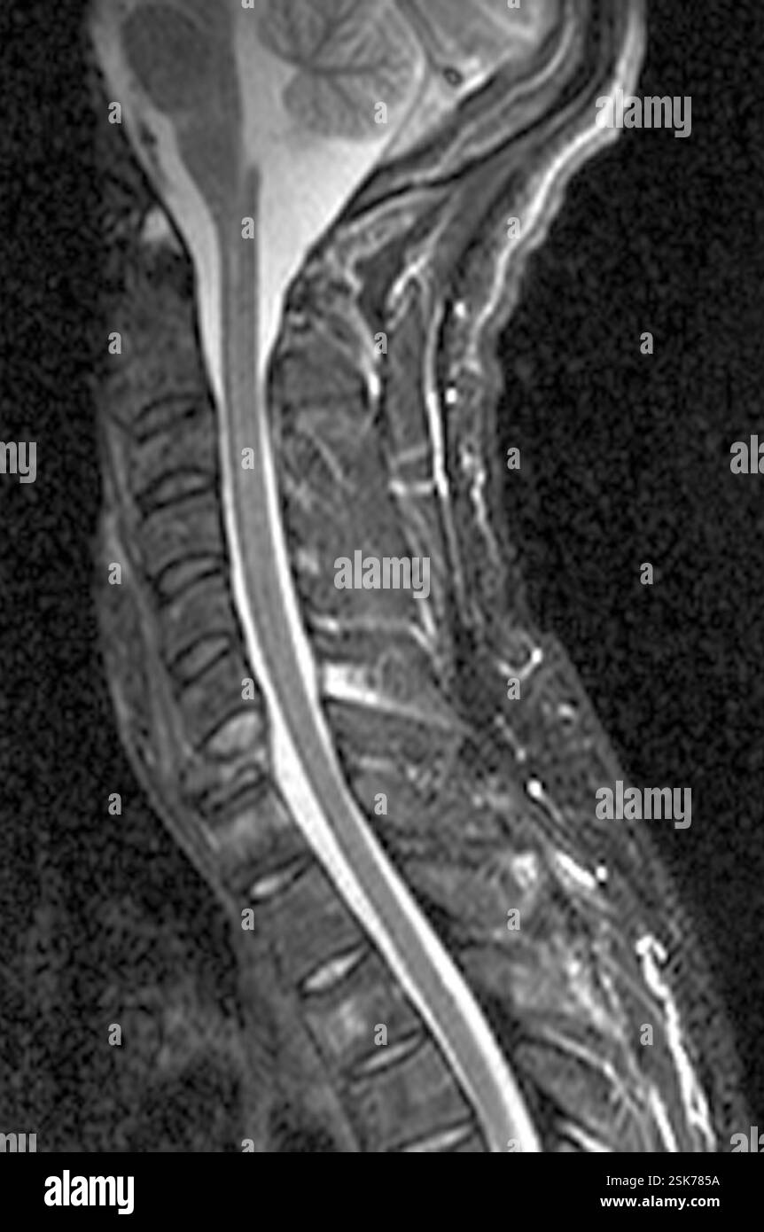 Imagerie par résonance magnétique (IRM) en coupe sagittale à travers la ...