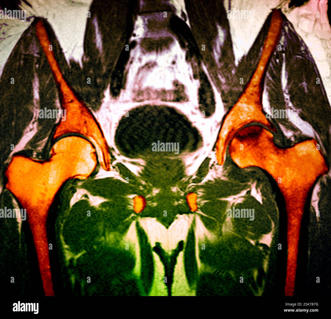 Imagerie par résonance magnétique (IRM) colorée vue de face de la ...