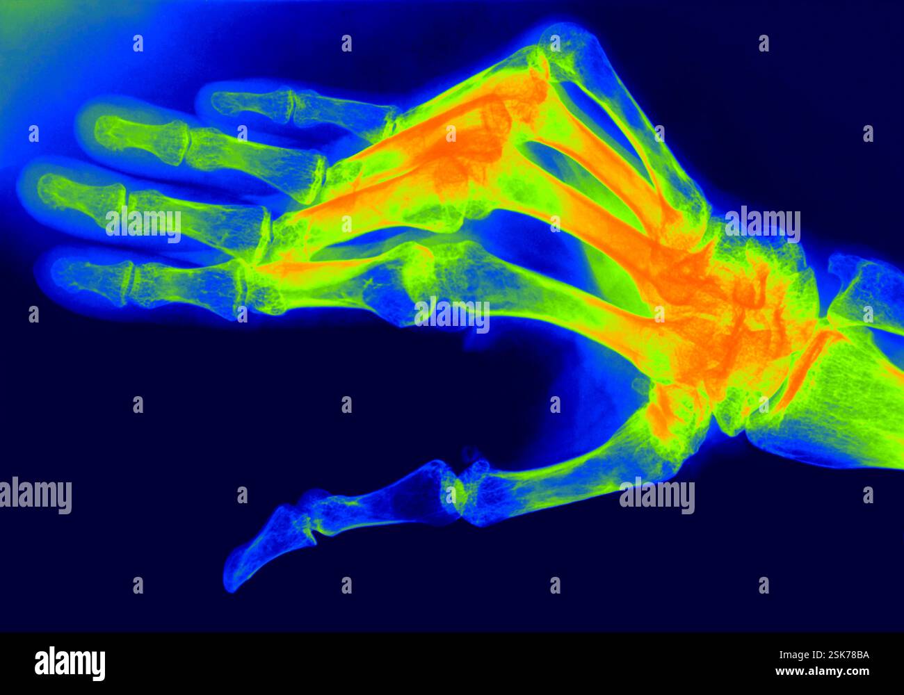 Radiographie colorée de la main droite d'un patient, montrant une ...