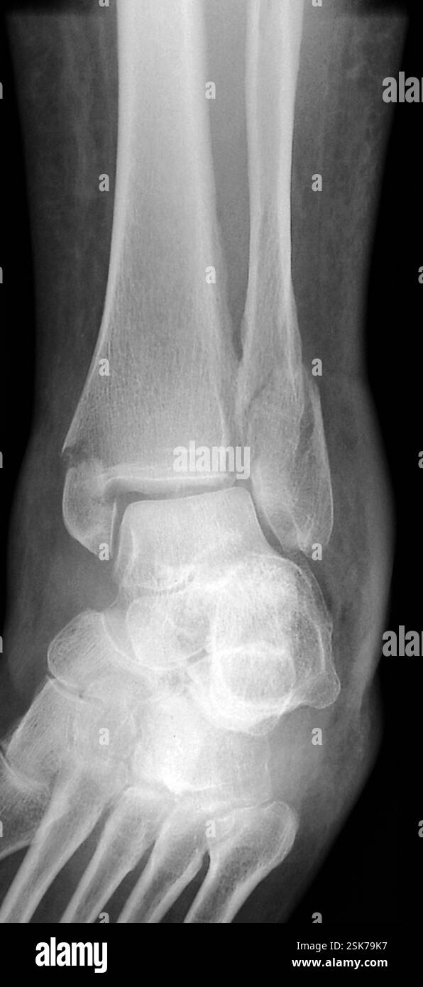 Cheville cassée. Radiographie de la cheville chez un homme de 60 ans ...