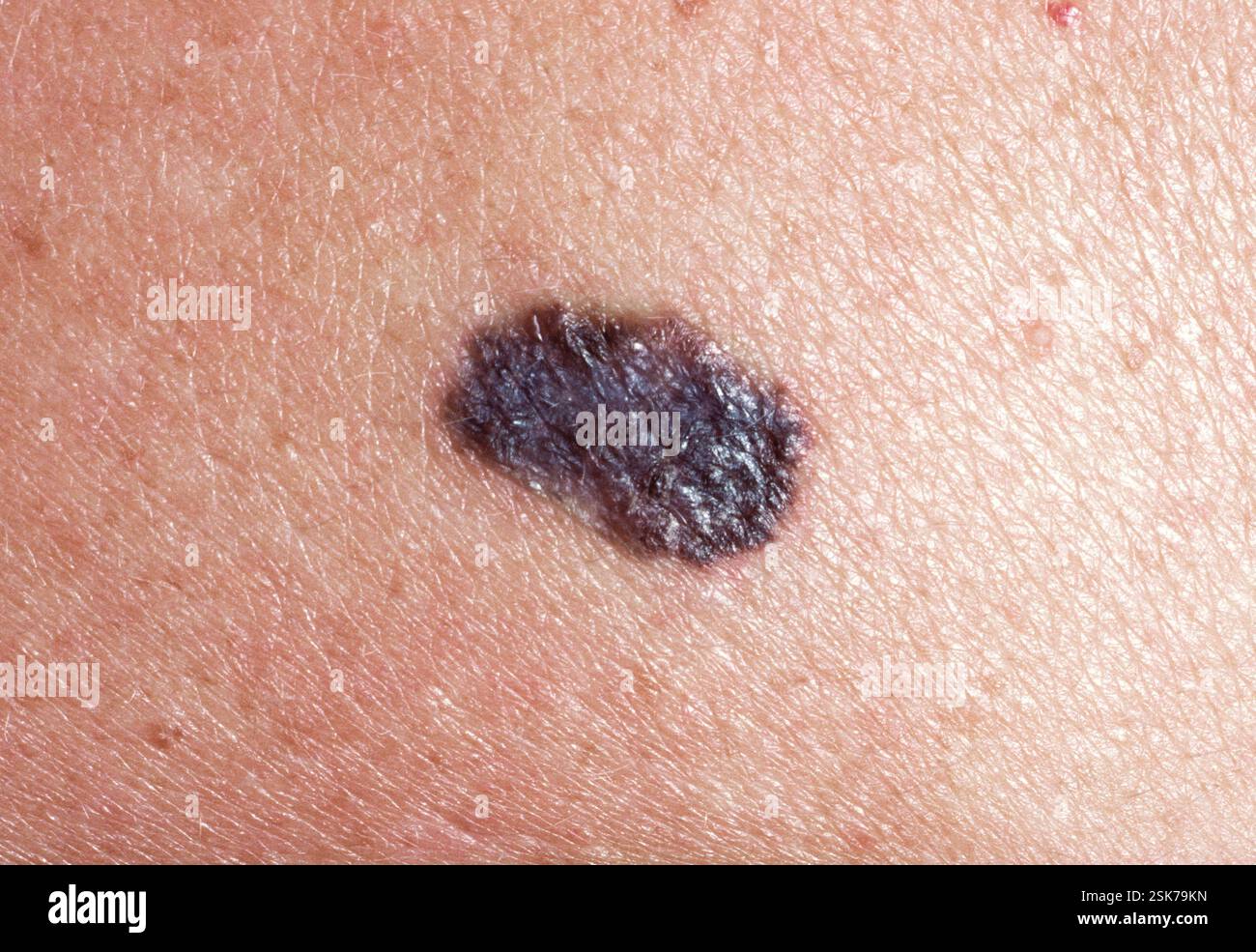 Mélanome malin. Gros plan d'un mélanome malin (cancéreux) sur la peau d ...