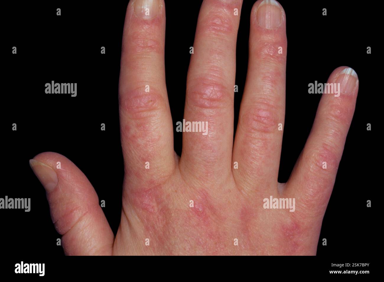 Dermatomyosite. Gros plan des zones enflammées rouges (papules de ...