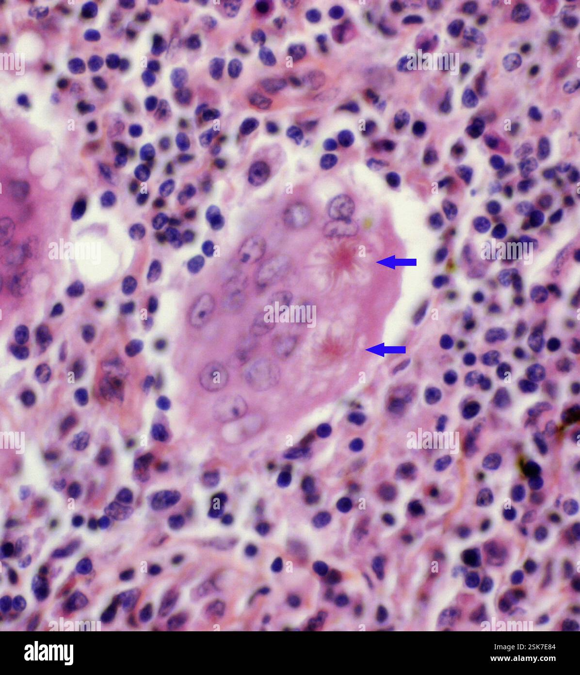 Sarcoïdose. Micrographie à la lumière d'une coupe tissulaire d'un ...
