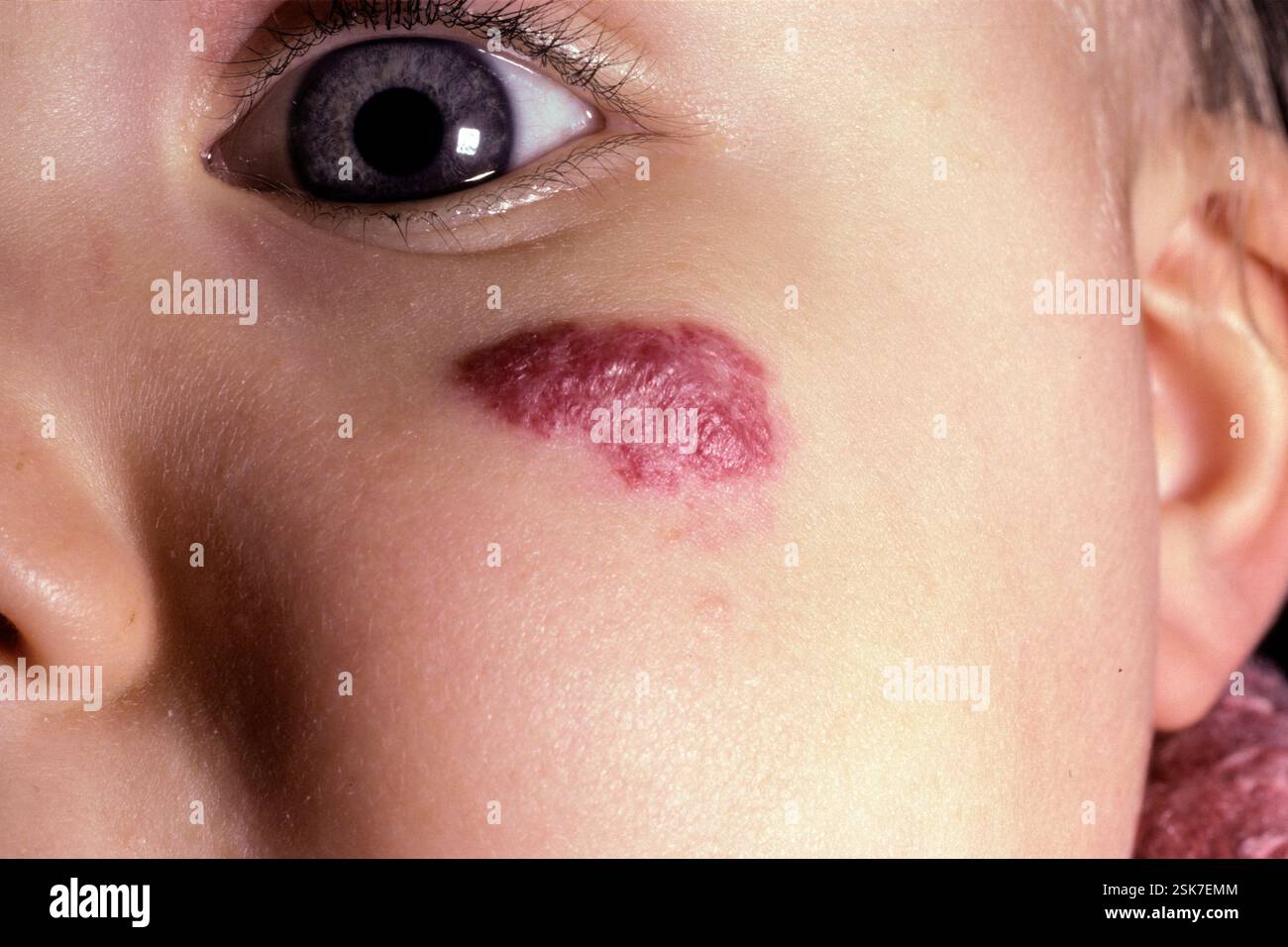 Angiome tubéreux de la face d'un enfant. Un angiome est une croissance ...