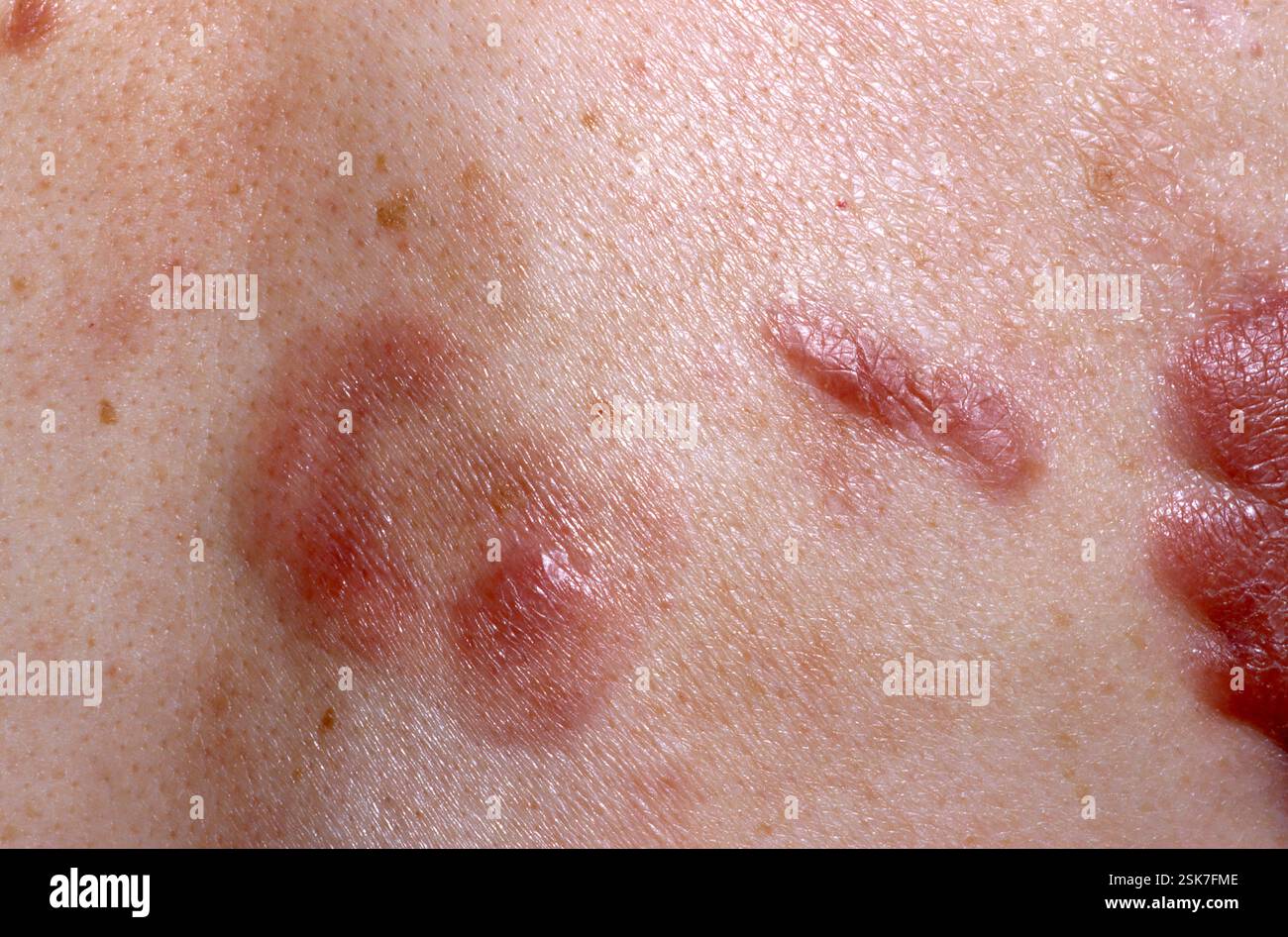 La peau dans le cancer à mycosis fongoïde. Gros plan des lésions ...