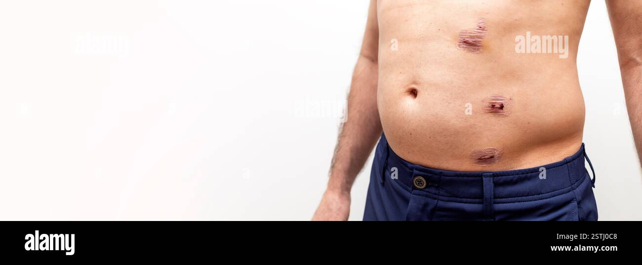 Chirurgie de l'appendicectomie laparoscopique à banderole. Trois ...