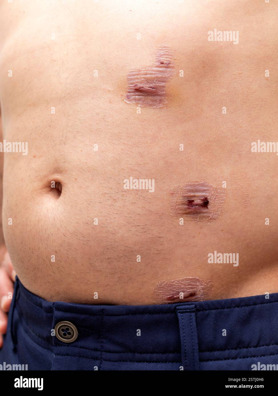 Chirurgie de l'appendicectomie laparoscopique en gros plan. Trois ...