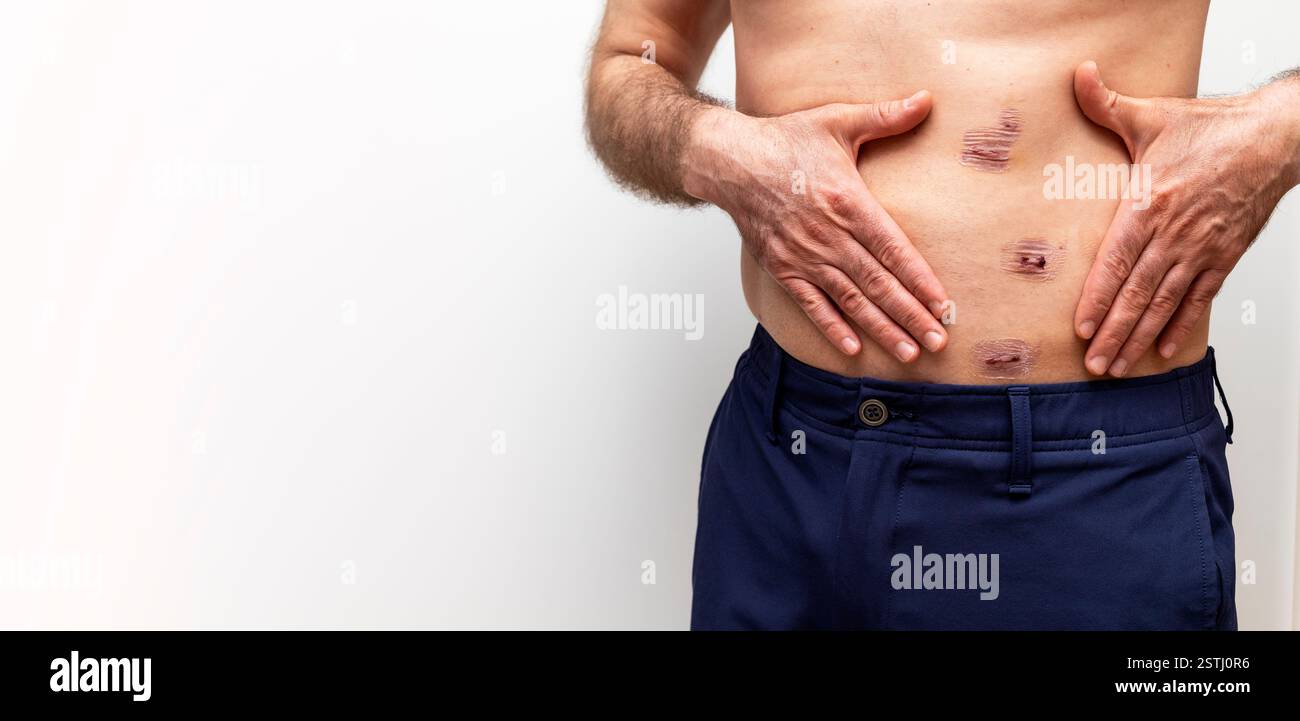 Appendicectomie laparoscopique par gabarit. Chirurgie. Soins des cicatrices dans la région ...