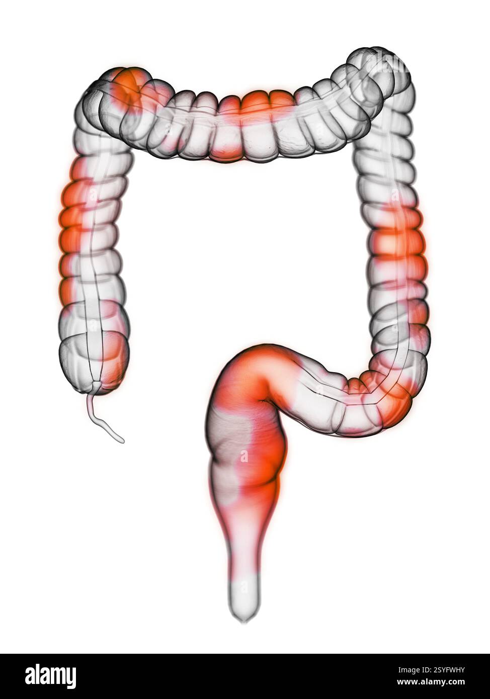 Inflammation rectale Banque de photographies et d’images à haute ...