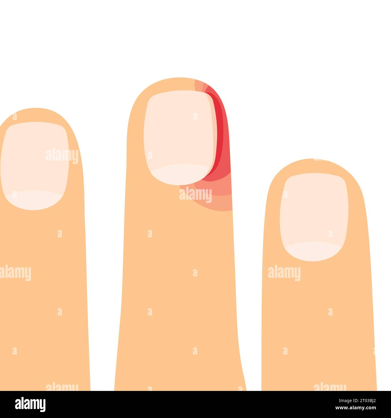 Panaris doigt Banque d'images vectorielles - Alamy