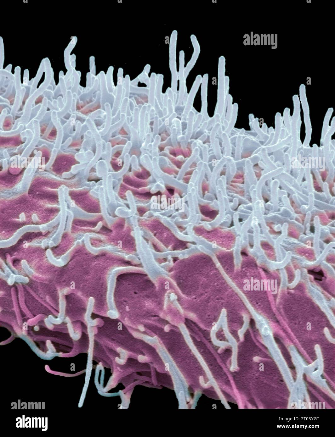 Cellule cancéreuse cérébrale. Détail en microscopie électronique à ...
