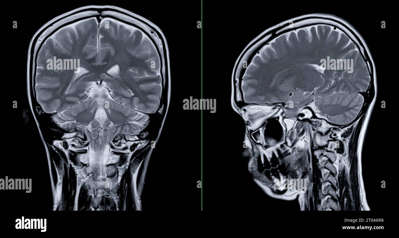 IRM scanner du cerveau pour détecter les maladies du cerveau sush comme ...