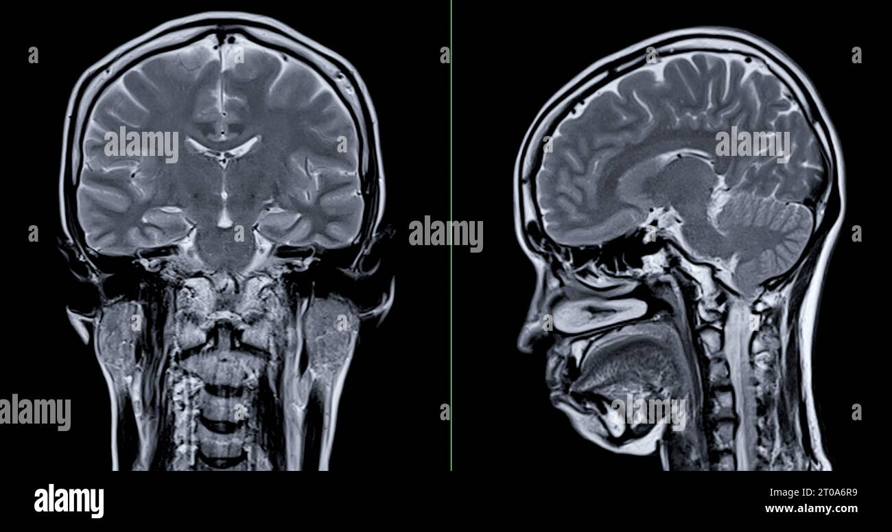 IRM scanner du cerveau pour détecter les maladies du cerveau sush comme ...