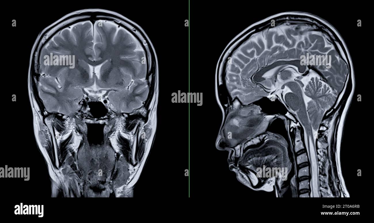 IRM scanner du cerveau pour détecter les maladies du cerveau sush comme ...