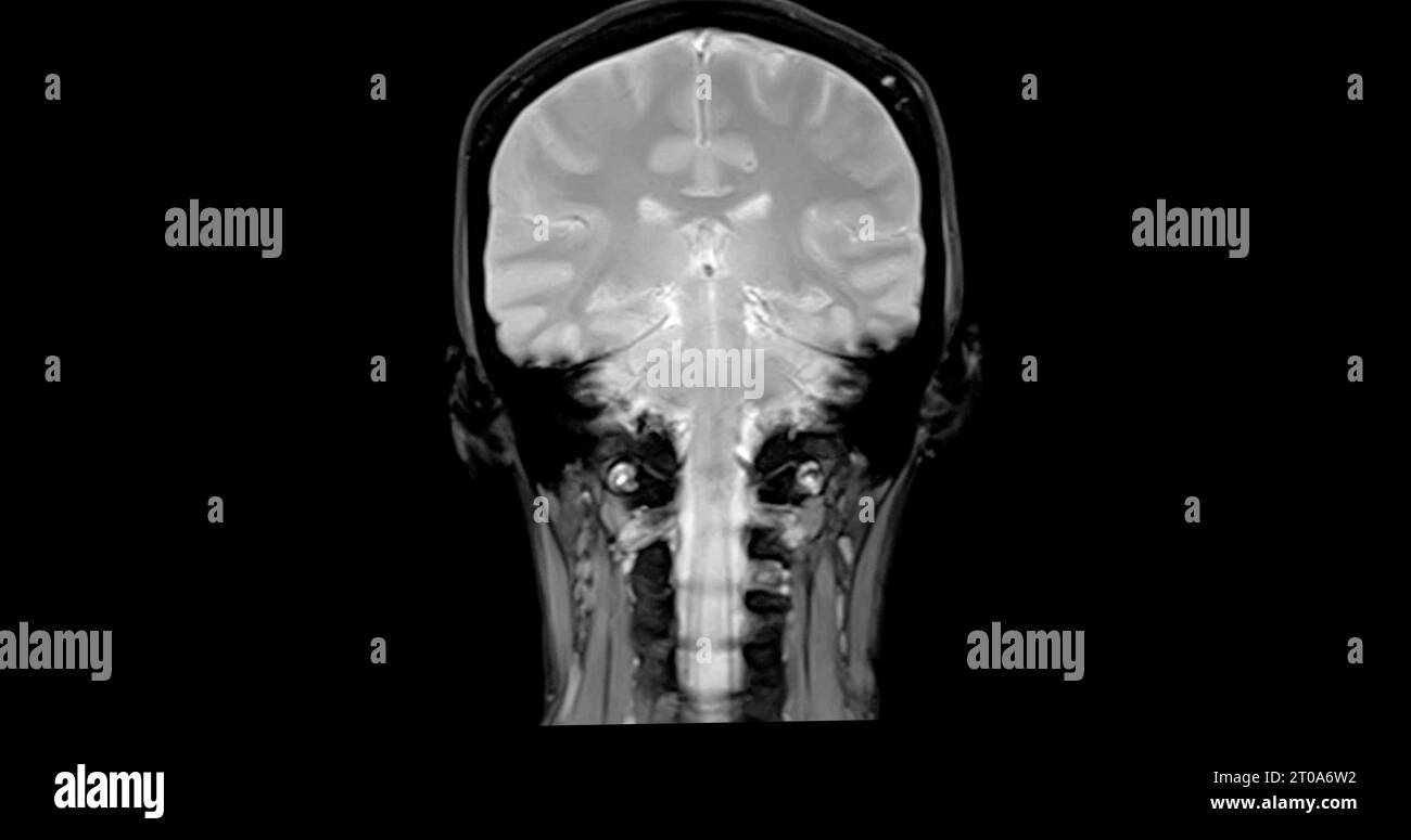 IRM scanner du cerveau pour détecter les maladies du cerveau sush comme maladie d'accident ...