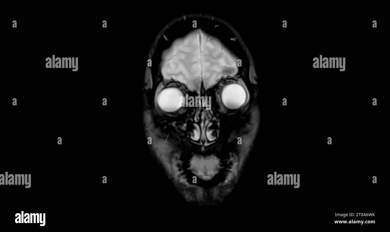 IRM scanner du cerveau pour détecter les maladies du cerveau sush comme ...