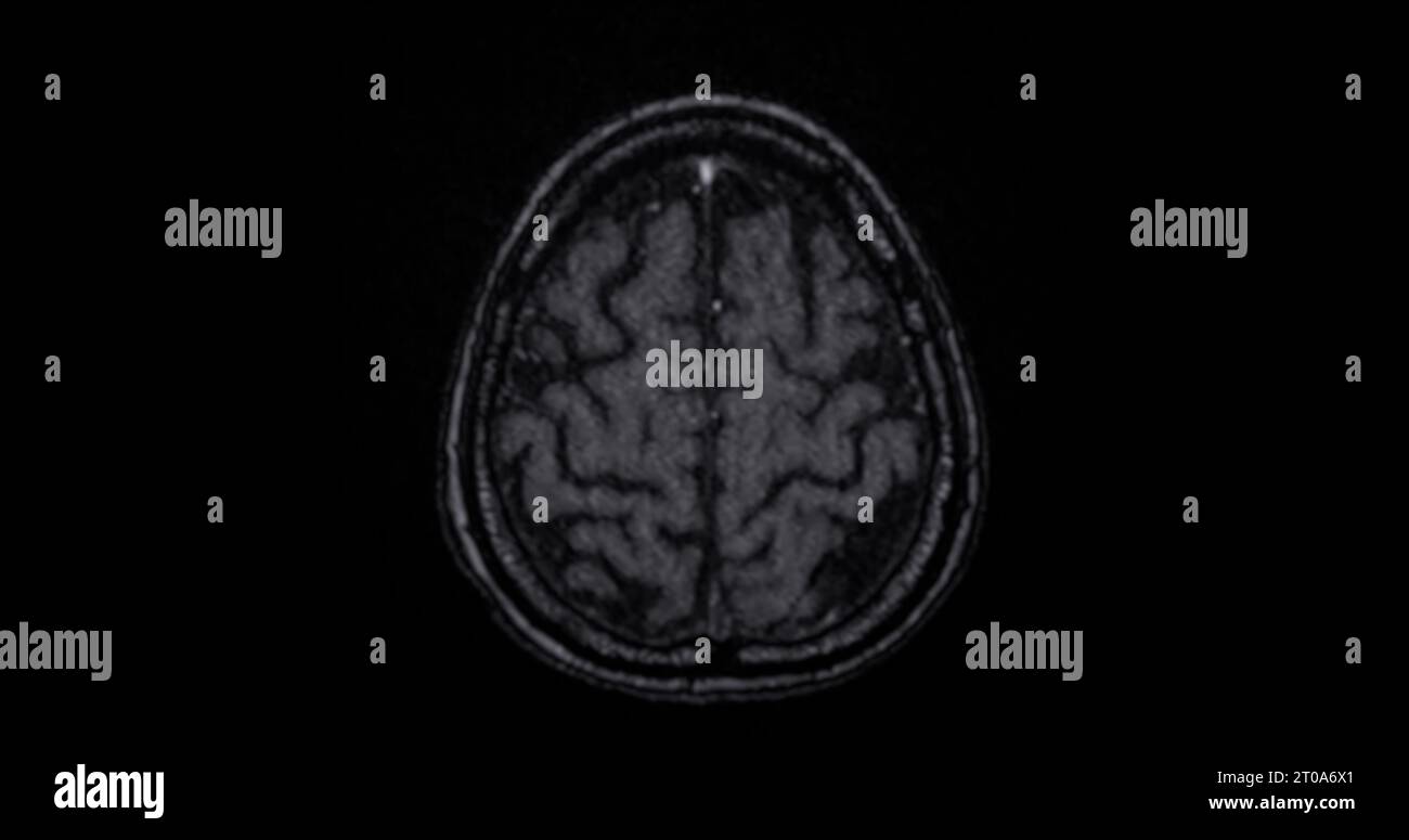 IRM scanner du cerveau pour détecter les maladies du cerveau sush comme ...
