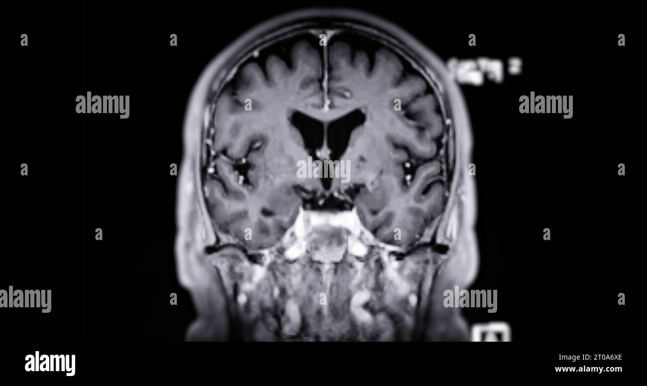 IRM scanner du cerveau pour détecter les maladies du cerveau sush comme ...