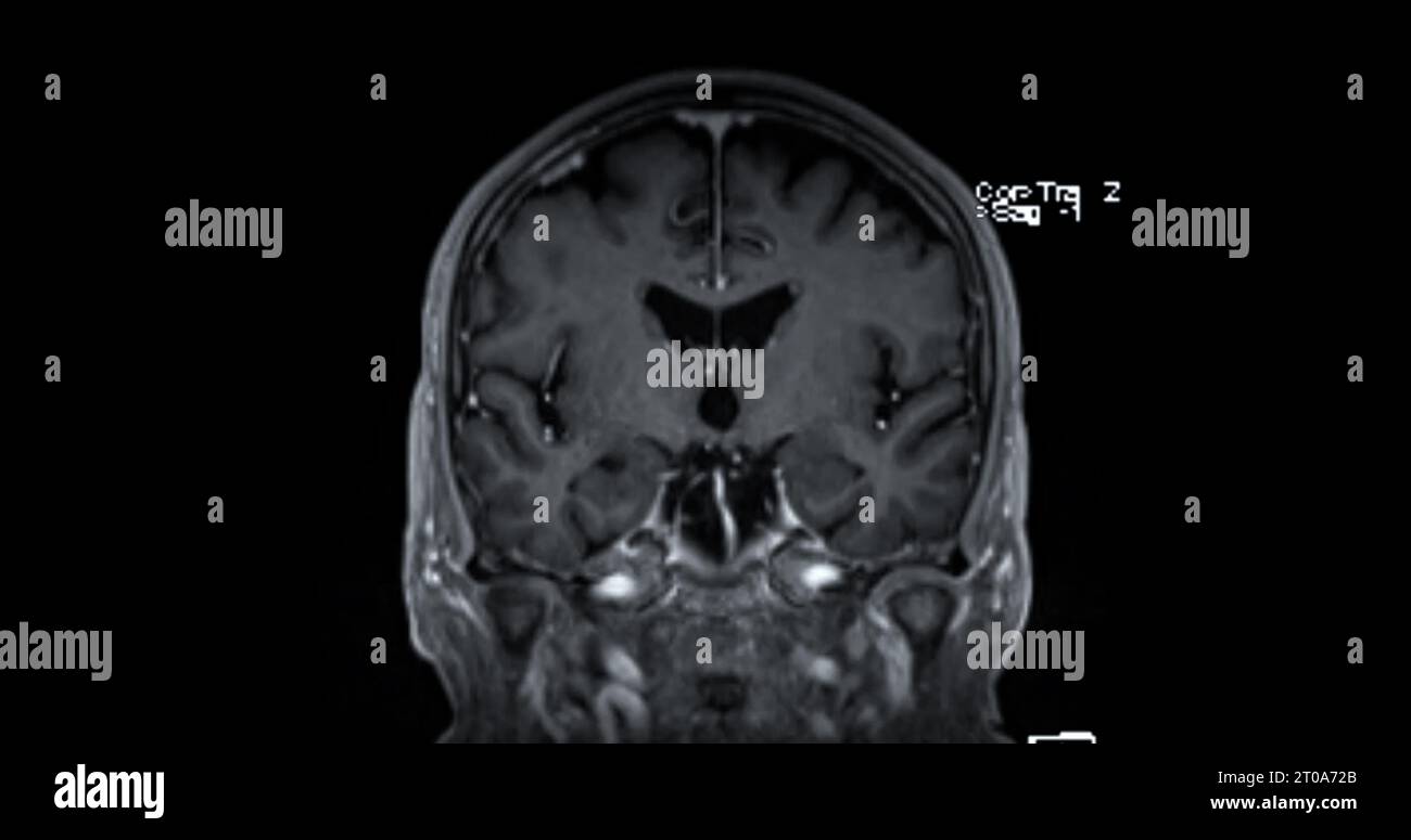 IRM scanner du cerveau pour détecter les maladies du cerveau sush comme maladie d'accident ...