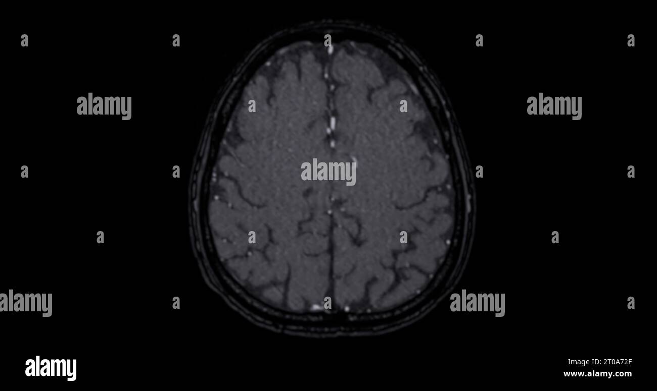 IRM scanner du cerveau pour détecter les maladies du cerveau sush comme ...