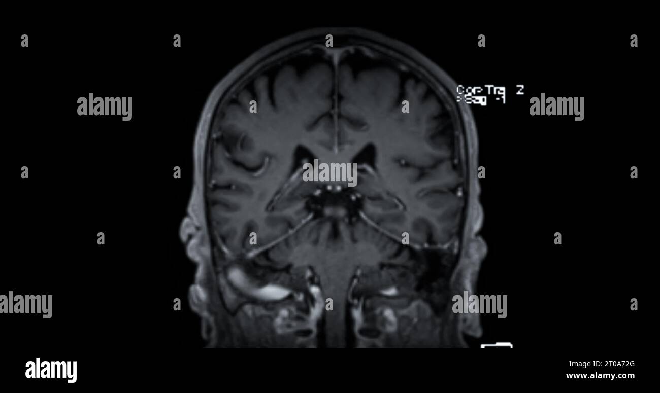 IRM scanner du cerveau pour détecter les maladies du cerveau sush comme ...