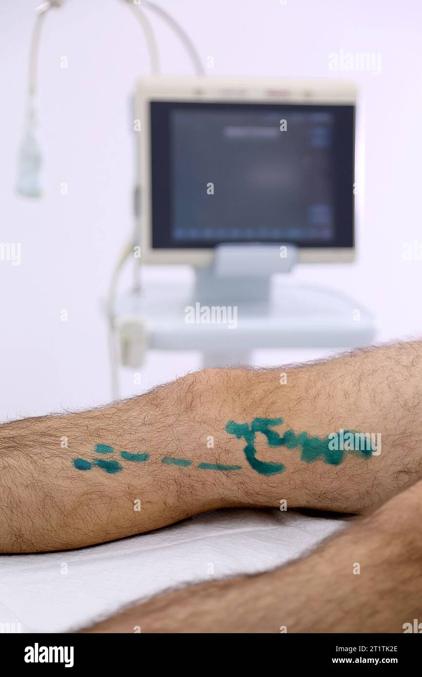 Chirurgie médicale de la photocoagulation endoveineuse au laser de la ...