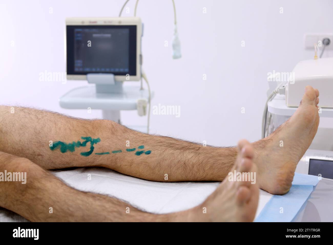 Chirurgie médicale de la photocoagulation endoveineuse au laser de la ...