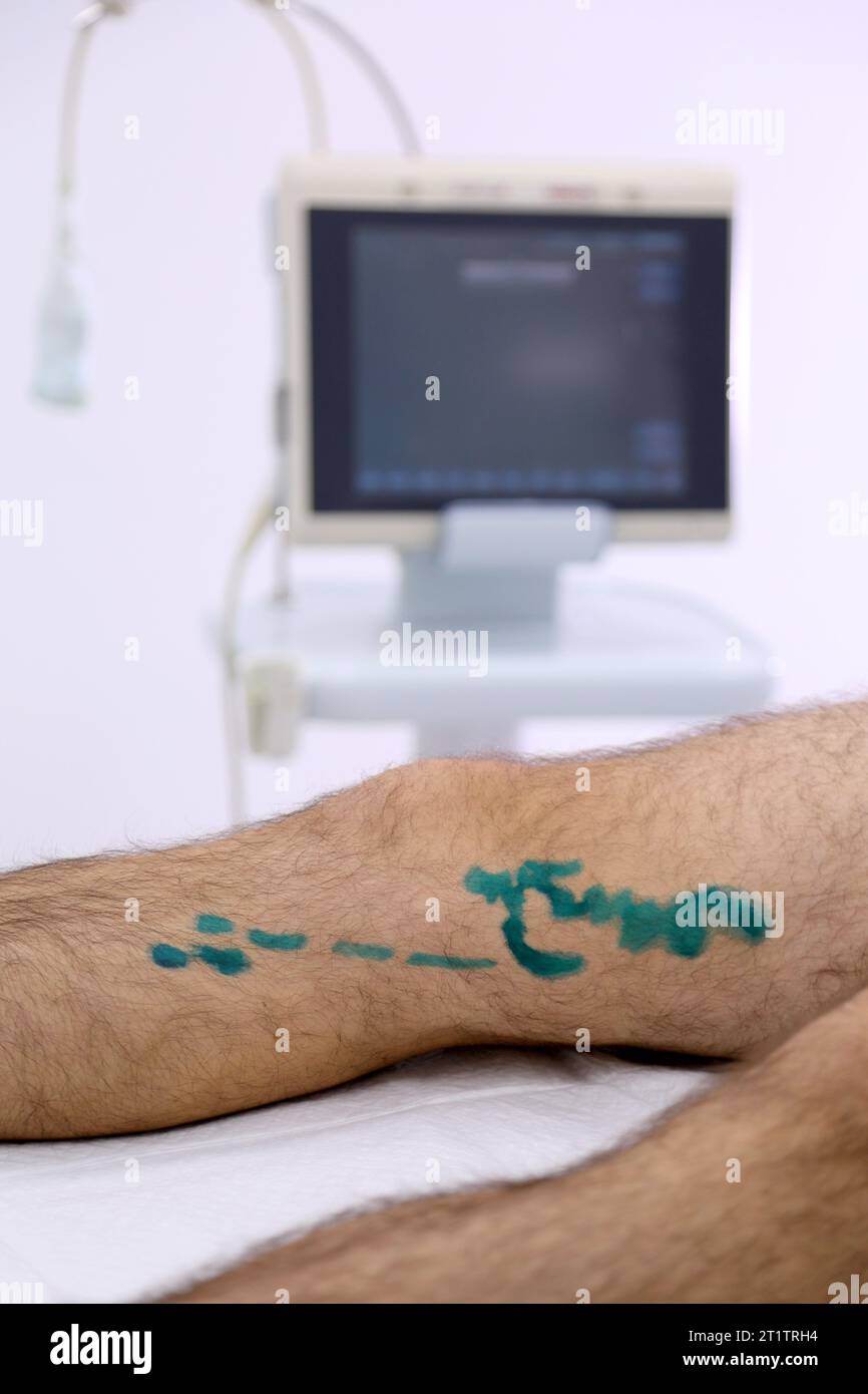 Chirurgie médicale de la photocoagulation endoveineuse au laser de la ...