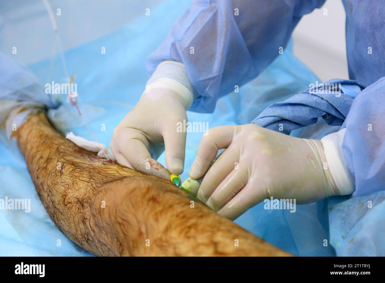 Chirurgie médicale de la photocoagulation endoveineuse au laser de la ...