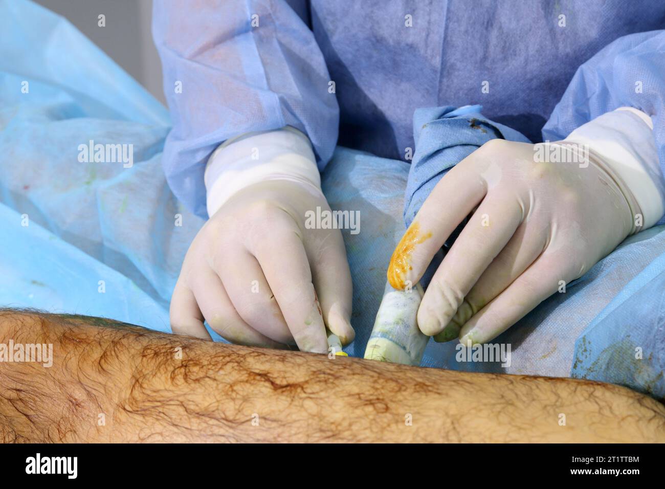 Chirurgie médicale de la photocoagulation endoveineuse au laser de la ...