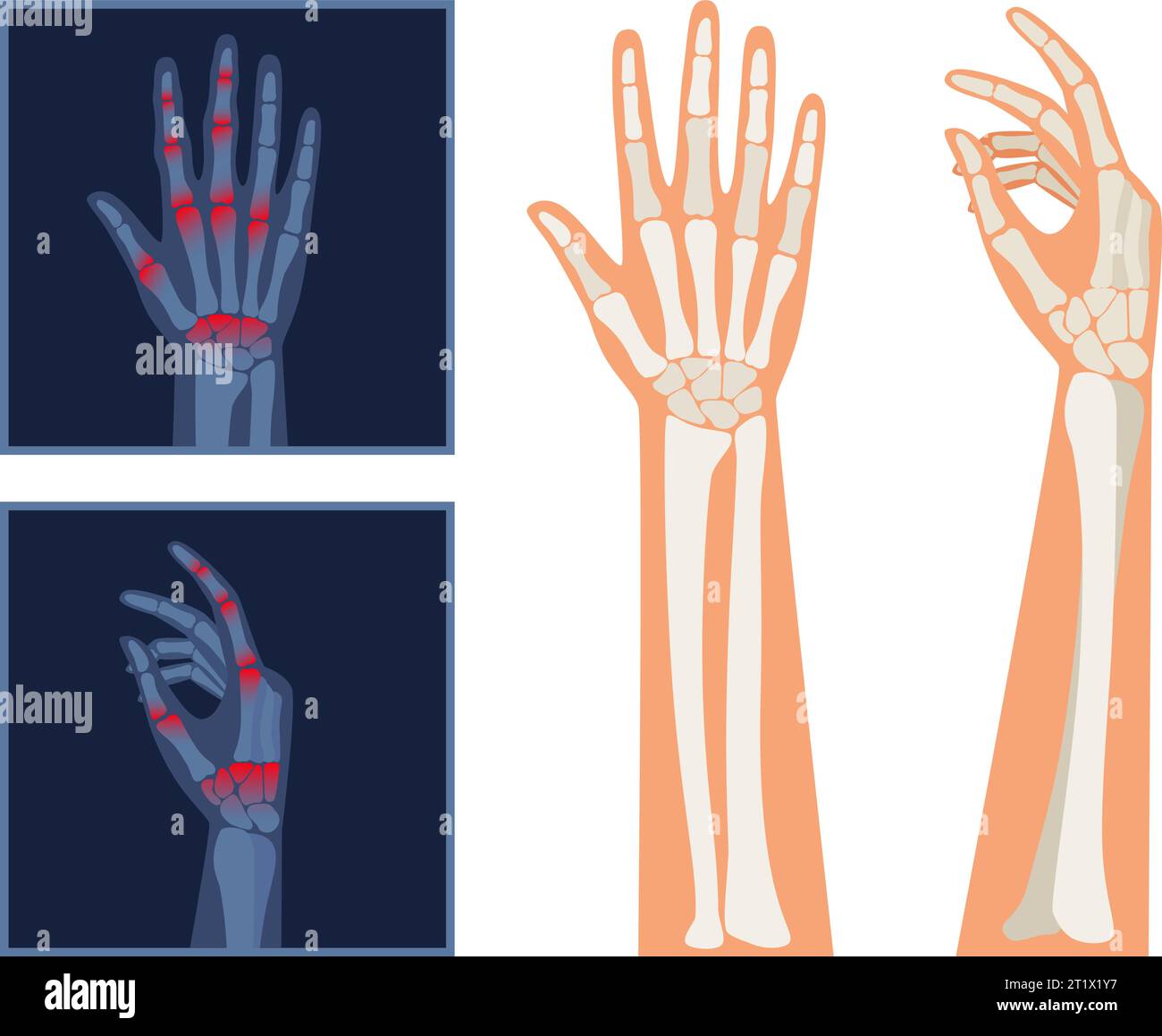 Illustration de vecteur d'arthrite de doigt. Radiographie des mains de ...