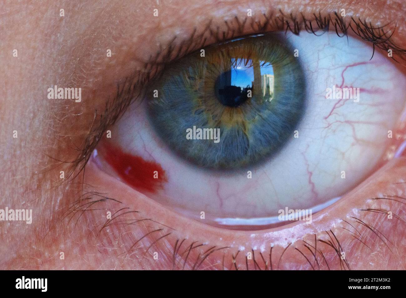 éclatement du vaisseau sanguin Banque de photographies et d’images à ...