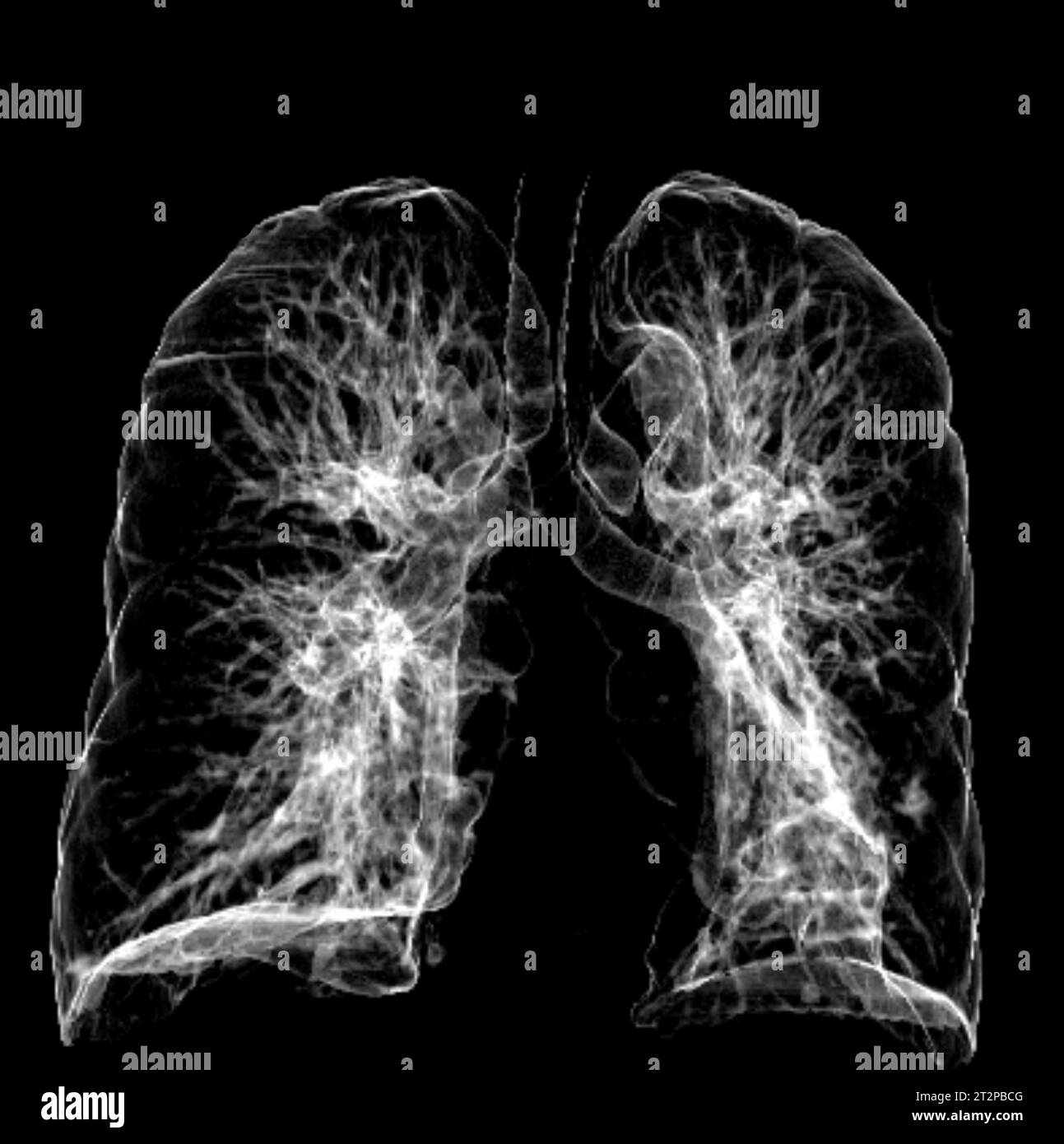 Scanner thoracique des poumons Banque d'images noir et blanc - Alamy