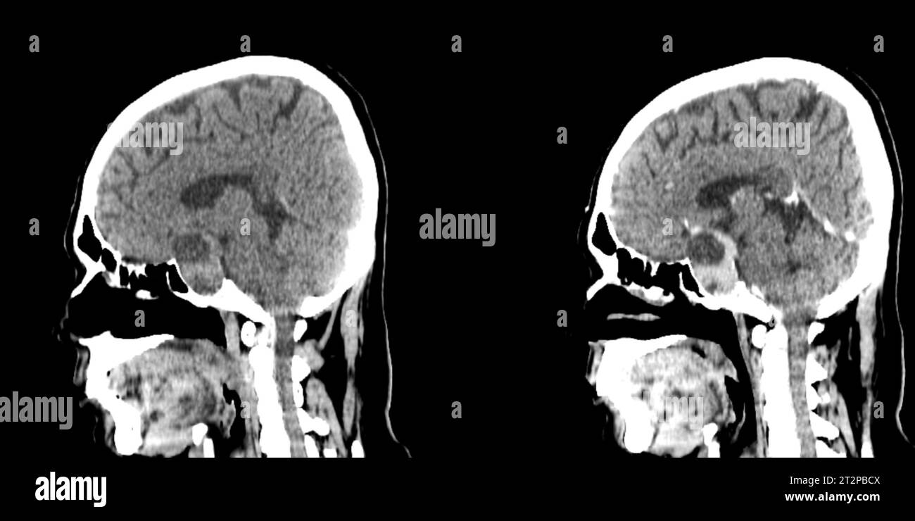 Sagittal ct Banque de photographies et d’images à haute résolution - Alamy