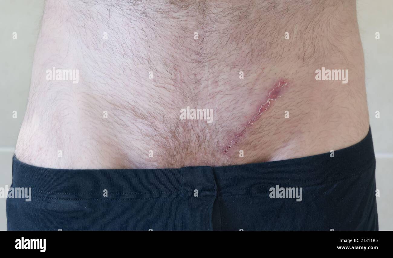 Hernia operation Banque de photographies et d’images à haute résolution ...