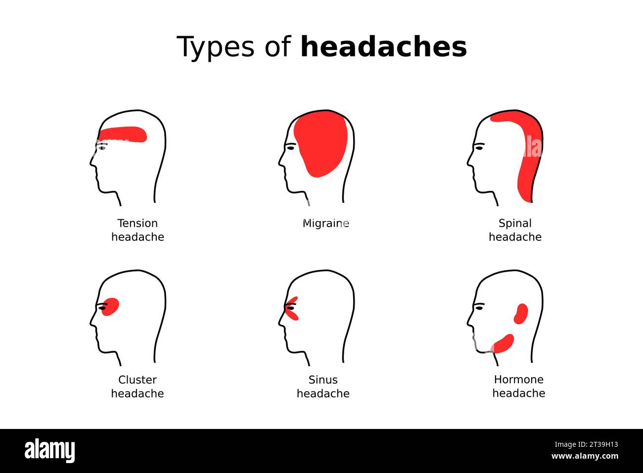 Types de maux de tête Banque de photographies et d’images à haute ...