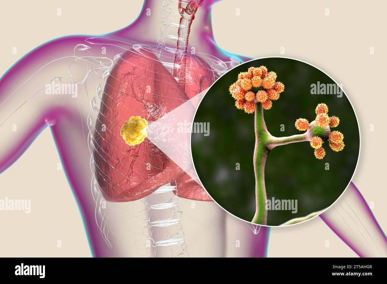 Mucormycose pulmonaire Banque de photographies et d’images à haute résolution - Alamy