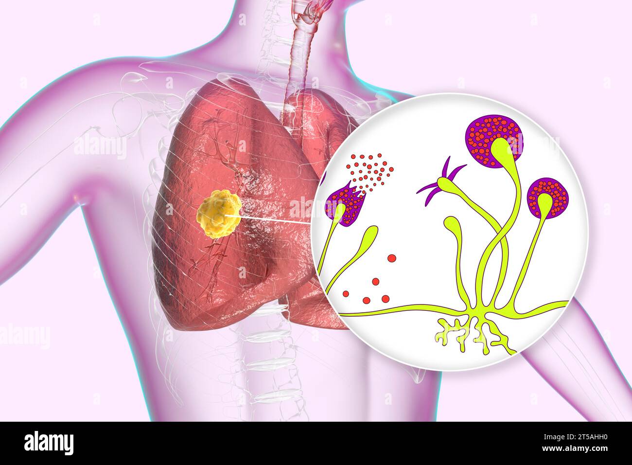 Mucormycose pulmonaire Banque de photographies et d’images à haute résolution - Alamy