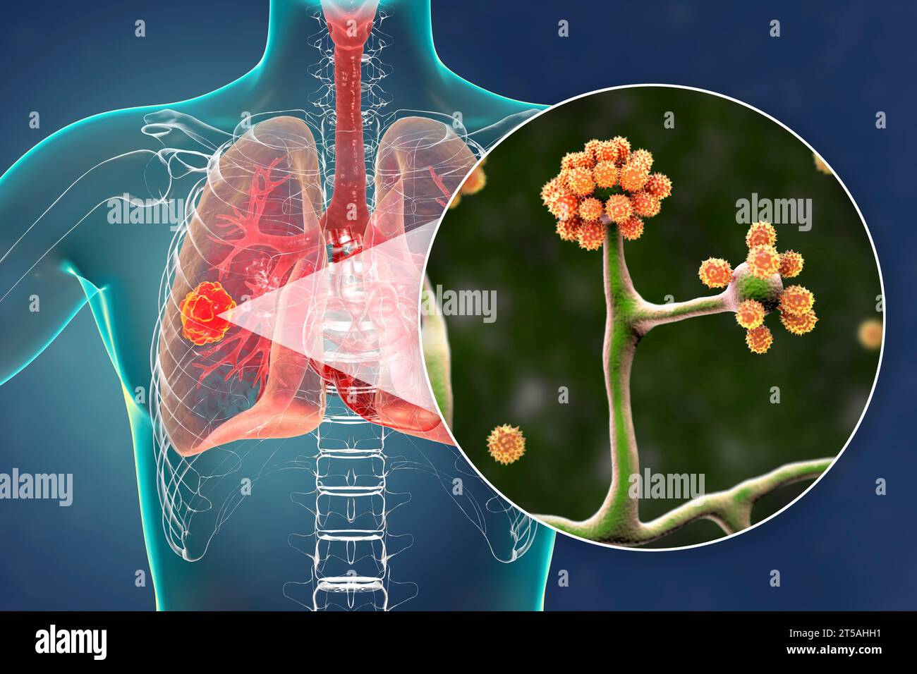 Mucormycose pulmonaire Banque de photographies et d’images à haute résolution - Alamy