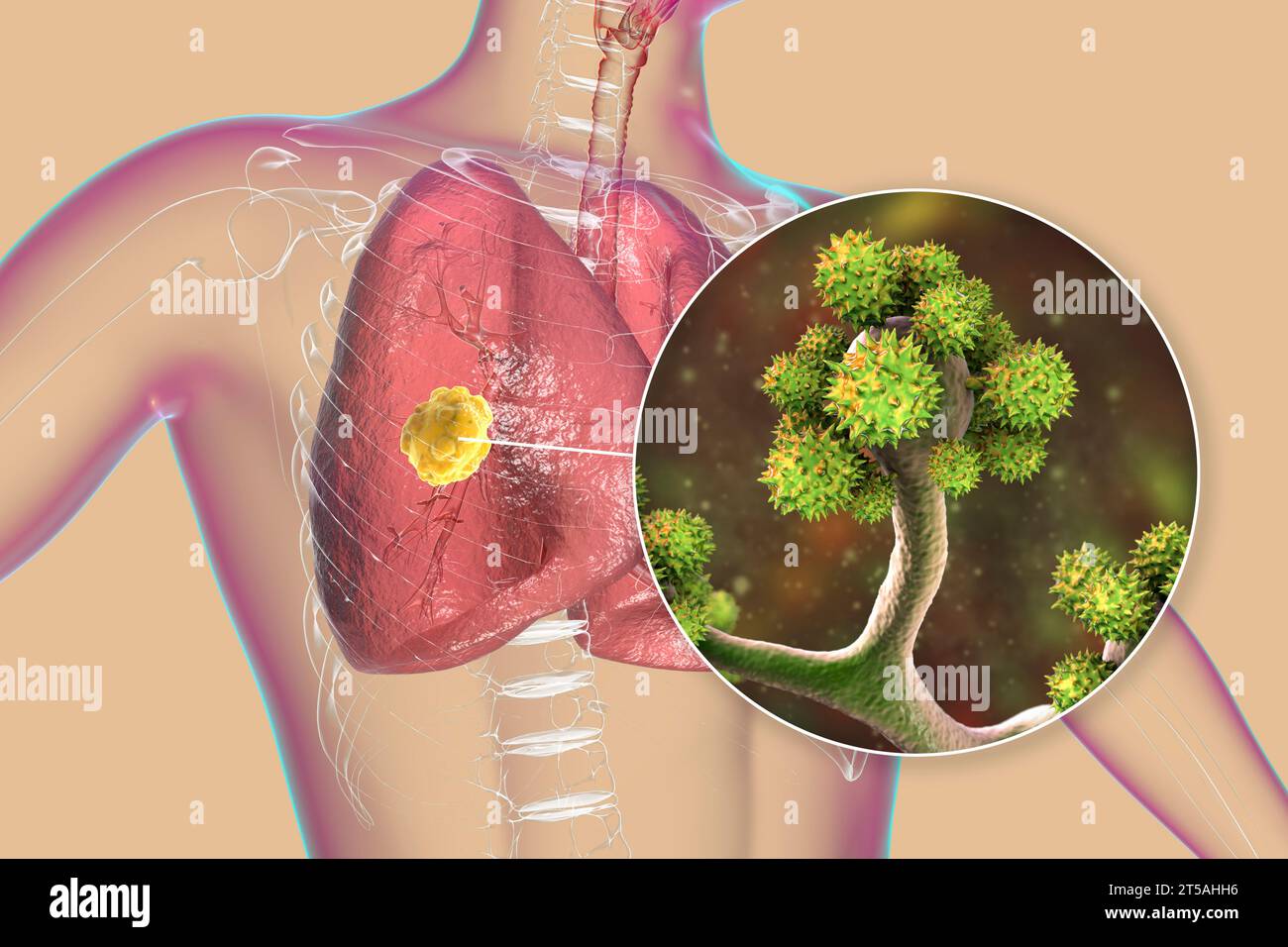 Mucormycose pulmonaire Banque de photographies et d’images à haute résolution - Alamy
