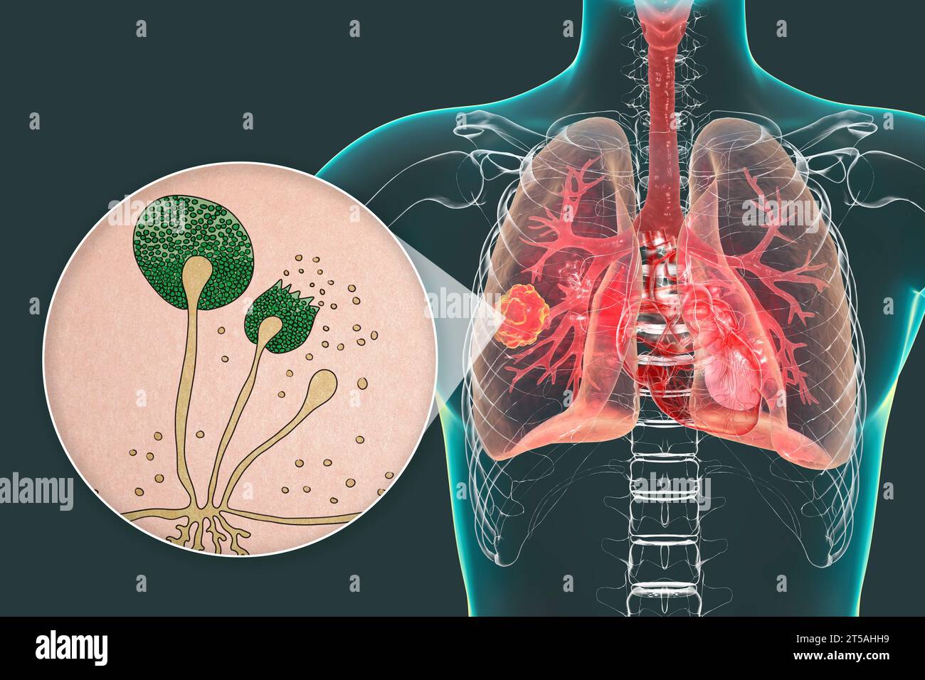 Mucormycose pulmonaire Banque de photographies et d’images à haute résolution - Alamy