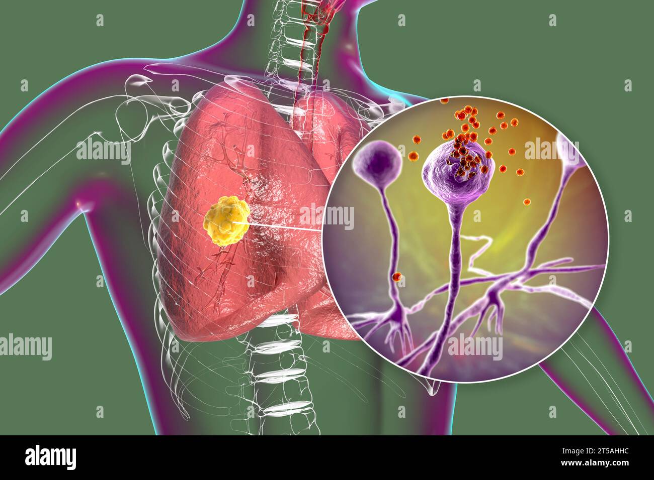 Mucormycose pulmonaire Banque de photographies et d’images à haute résolution - Alamy